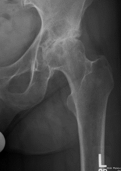 How Long Will My Hip Last? Durability in Hip Replacement Surgery ...