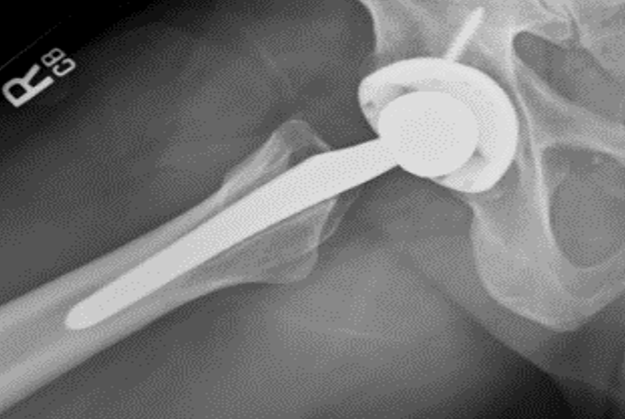 How Long Will My Hip Last? Durability in Hip Replacement Surgery