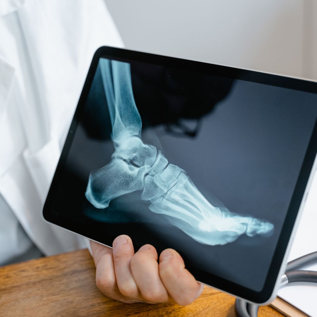 Common Types of Orthopedic Fractures and Their Treatments - Austin ...