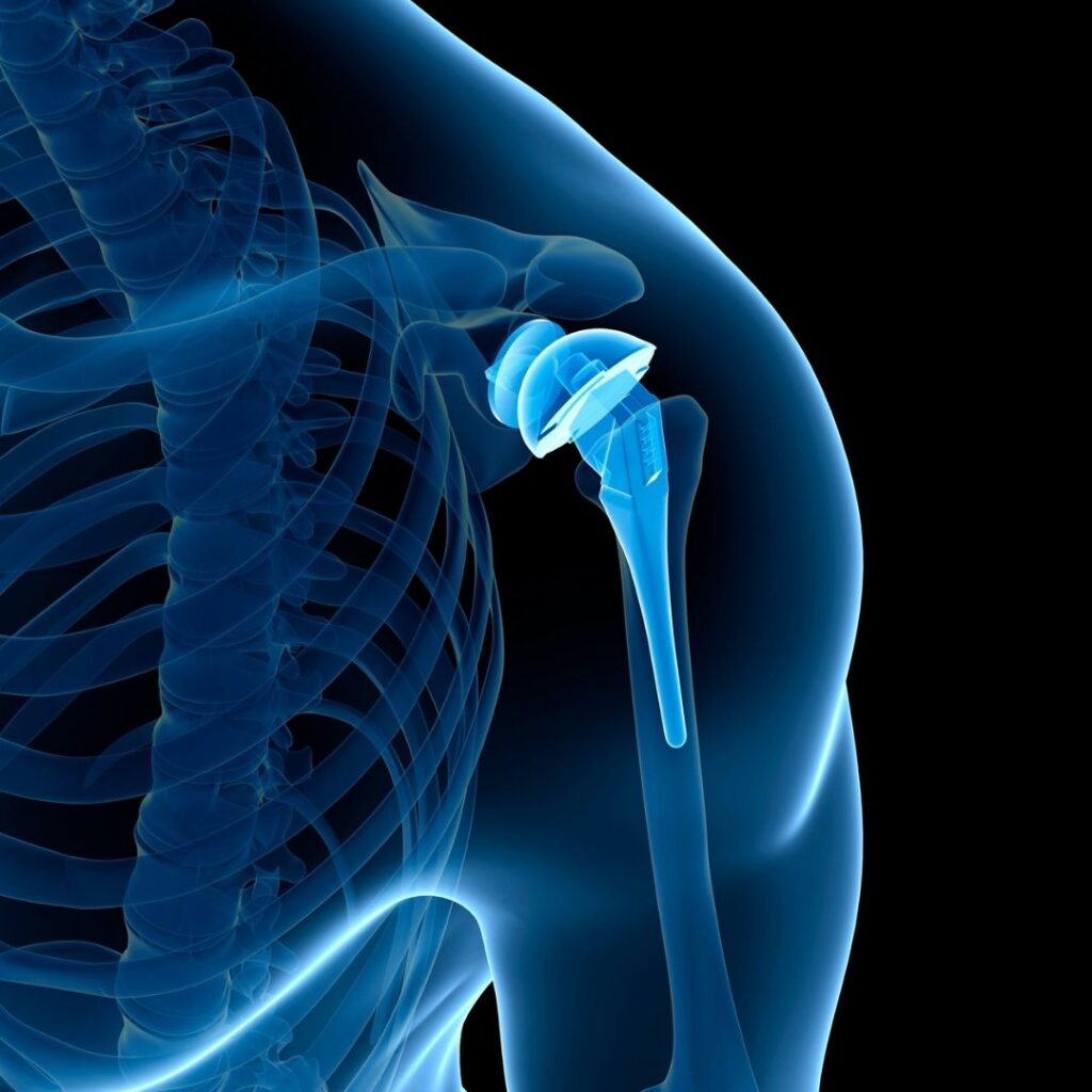 A Surgeon’s Perspective: Dr. Hurt on Reverse Shoulder Replacement ...